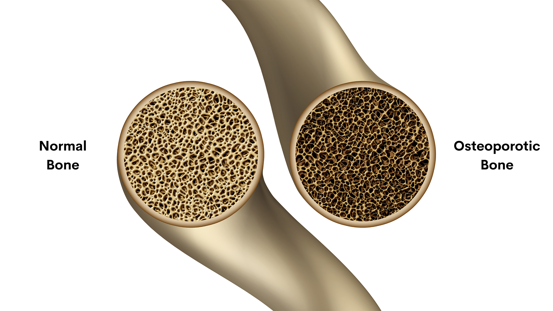 How Hormones Affect Your Bone Health - Aspen Diabetes & Endocrine Clinic